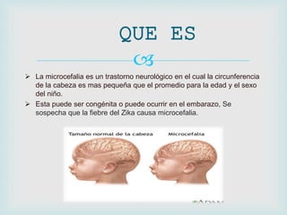 Microcefalia | PPTX