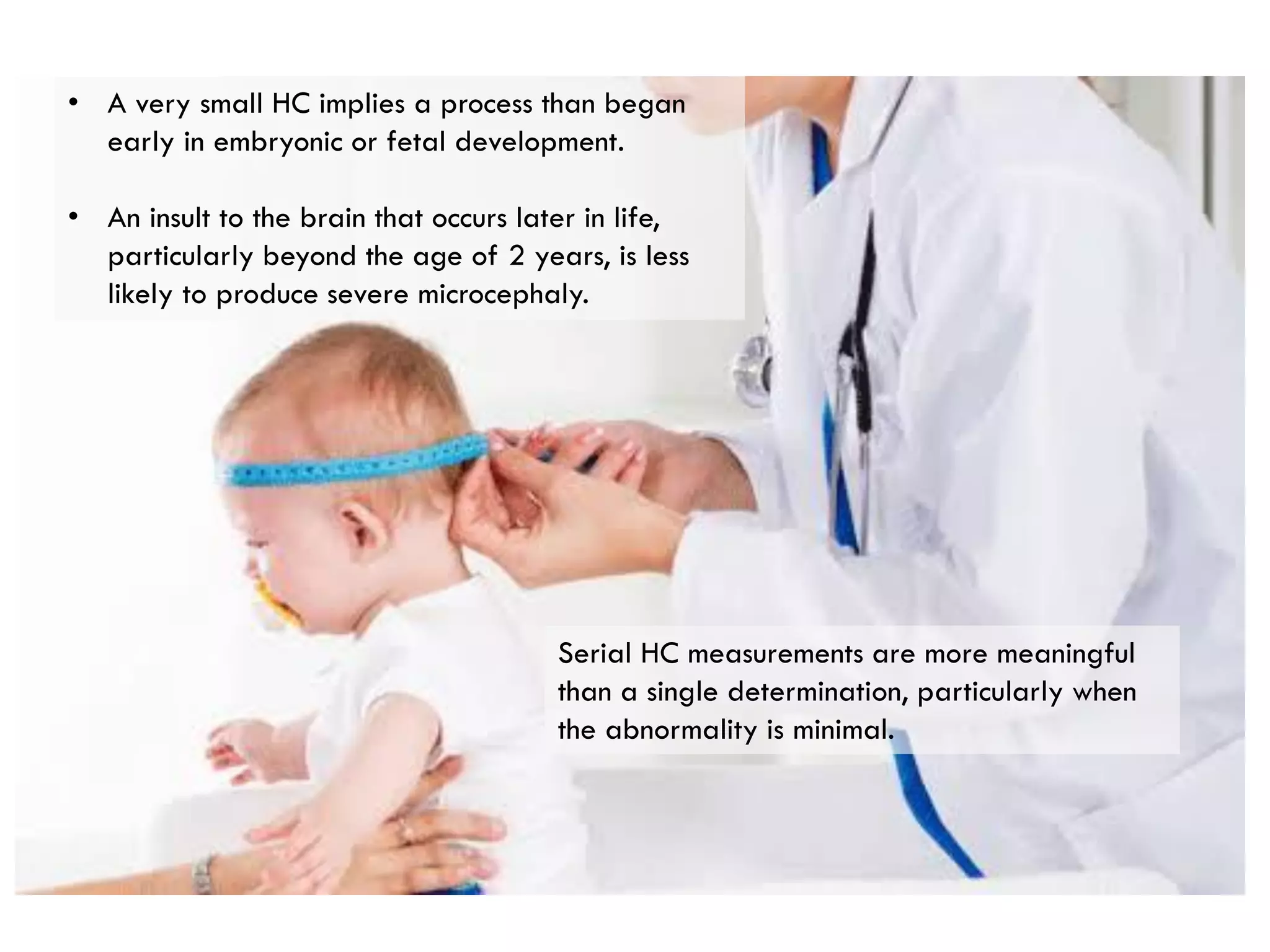 Microcephaly - For medical students | PDF