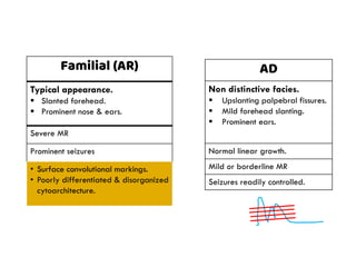 Microcephaly - For medical students | PDF