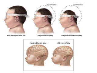 Microcephaly - For medical students | PDF
