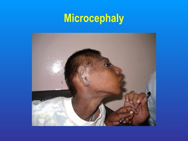 MICROCEPHALY.pptx paediatric ppt small head causes and management | PPTX