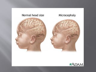 Microcephaly etiopathogenesis clinical features | PPTX