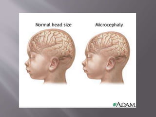 Microcephaly 3.pptx | Pregnancy | Reproductive Health