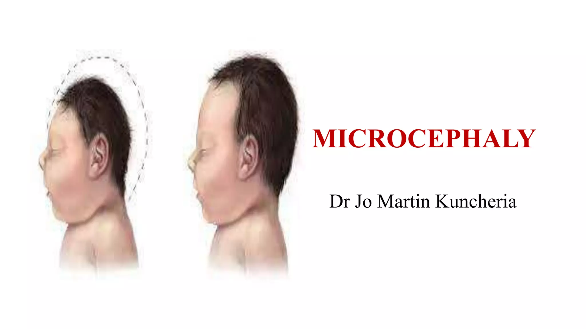 MICROCEPHALY jo.pptx