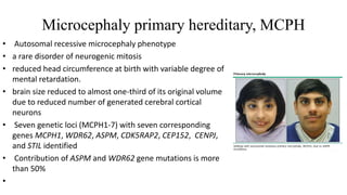 MICROCEPHALY jo.pptx