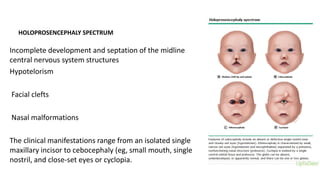 MICROCEPHALY jo.pptx