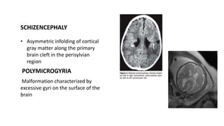 MICROCEPHALY jo.pptx