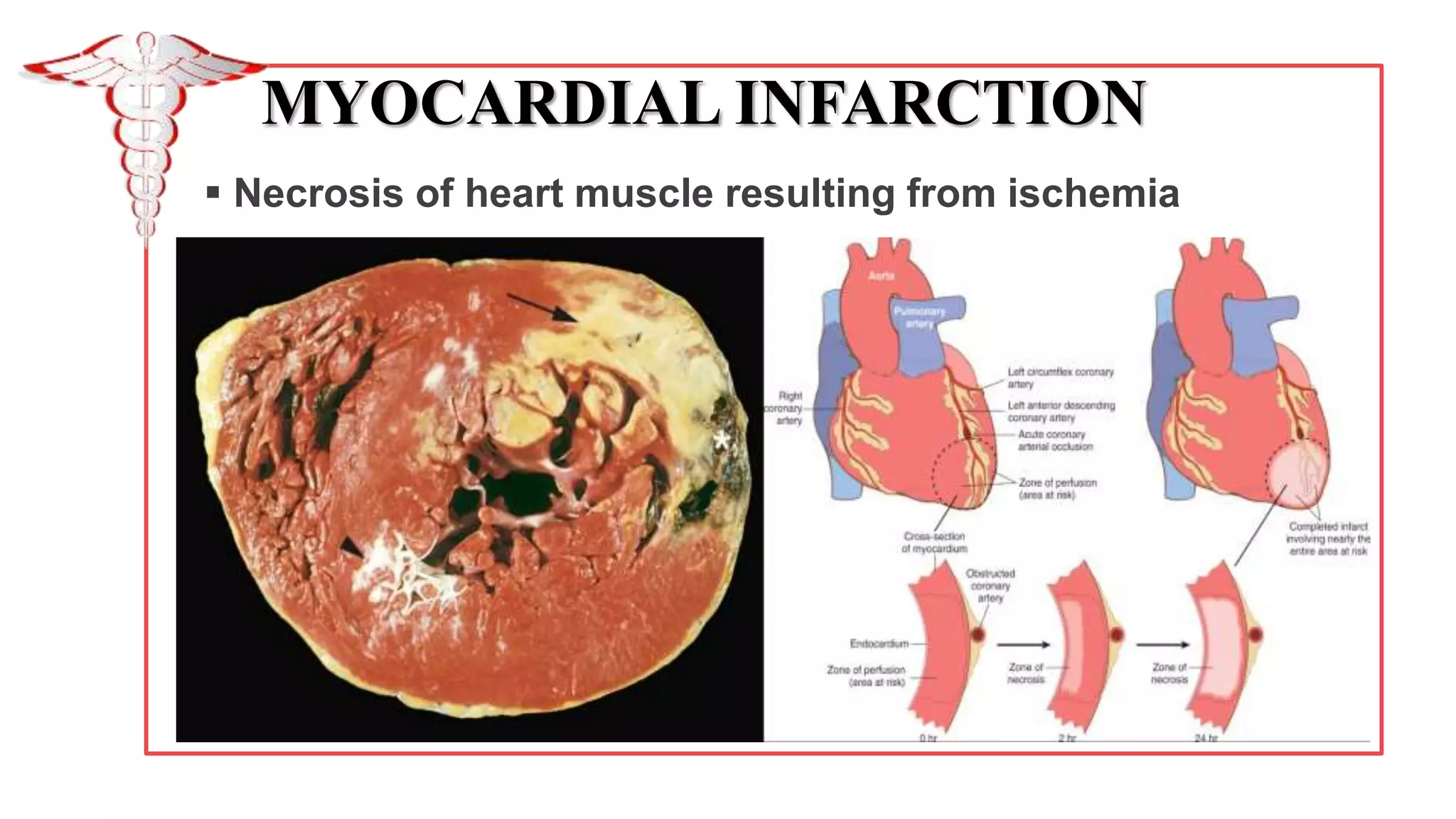 Microscopic changes in Myocardial Infarction | PPTX