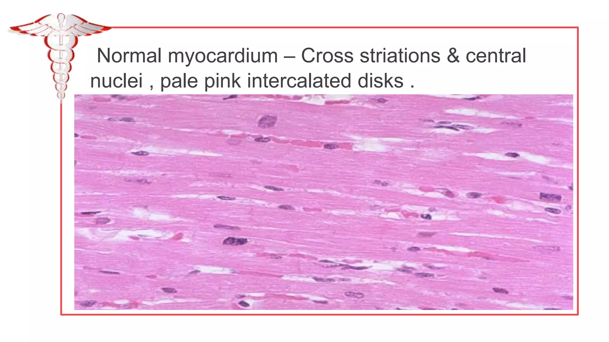 Microscopic changes in Myocardial Infarction | PPTX