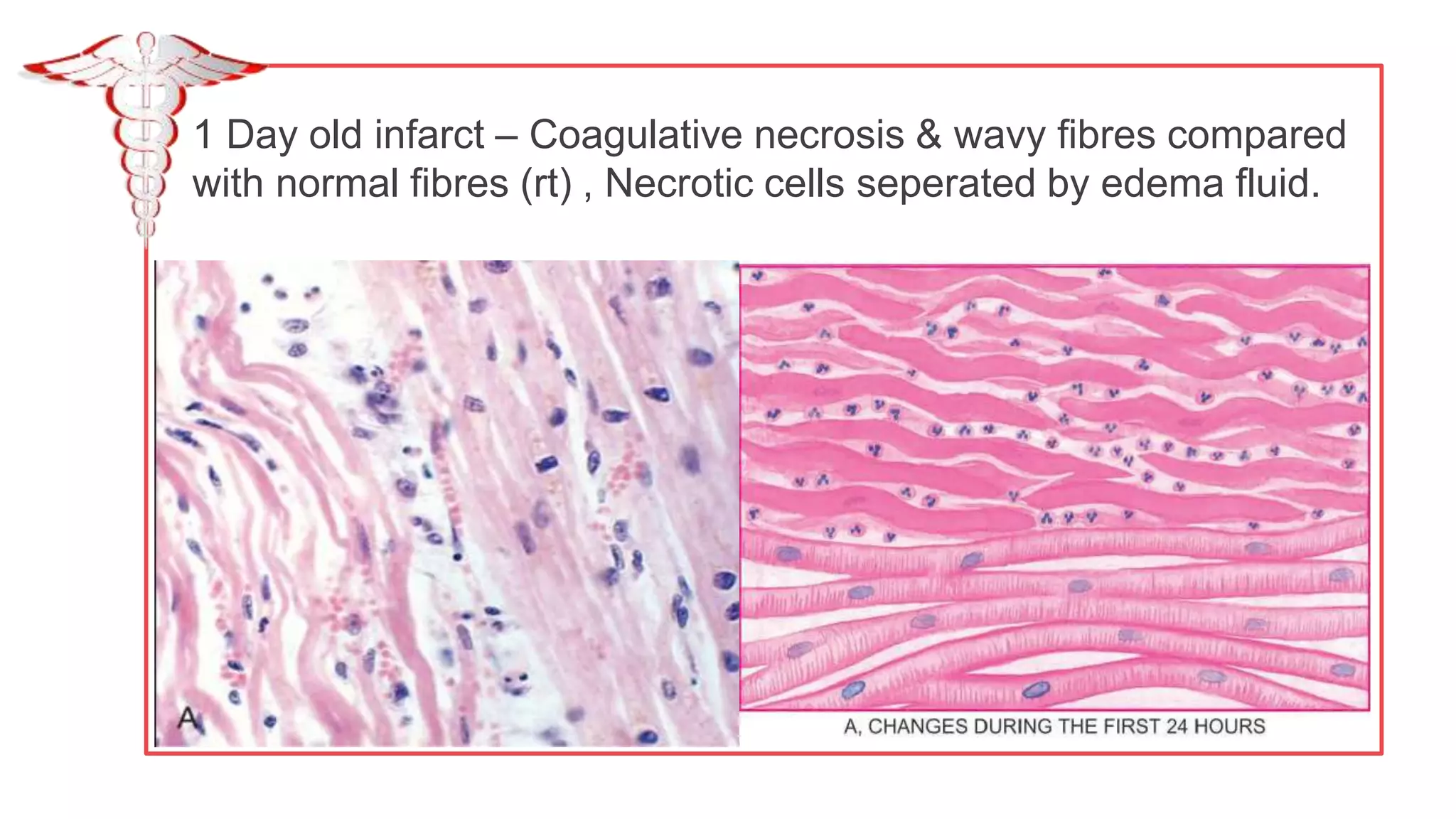 Microscopic changes in Myocardial Infarction | PPTX
