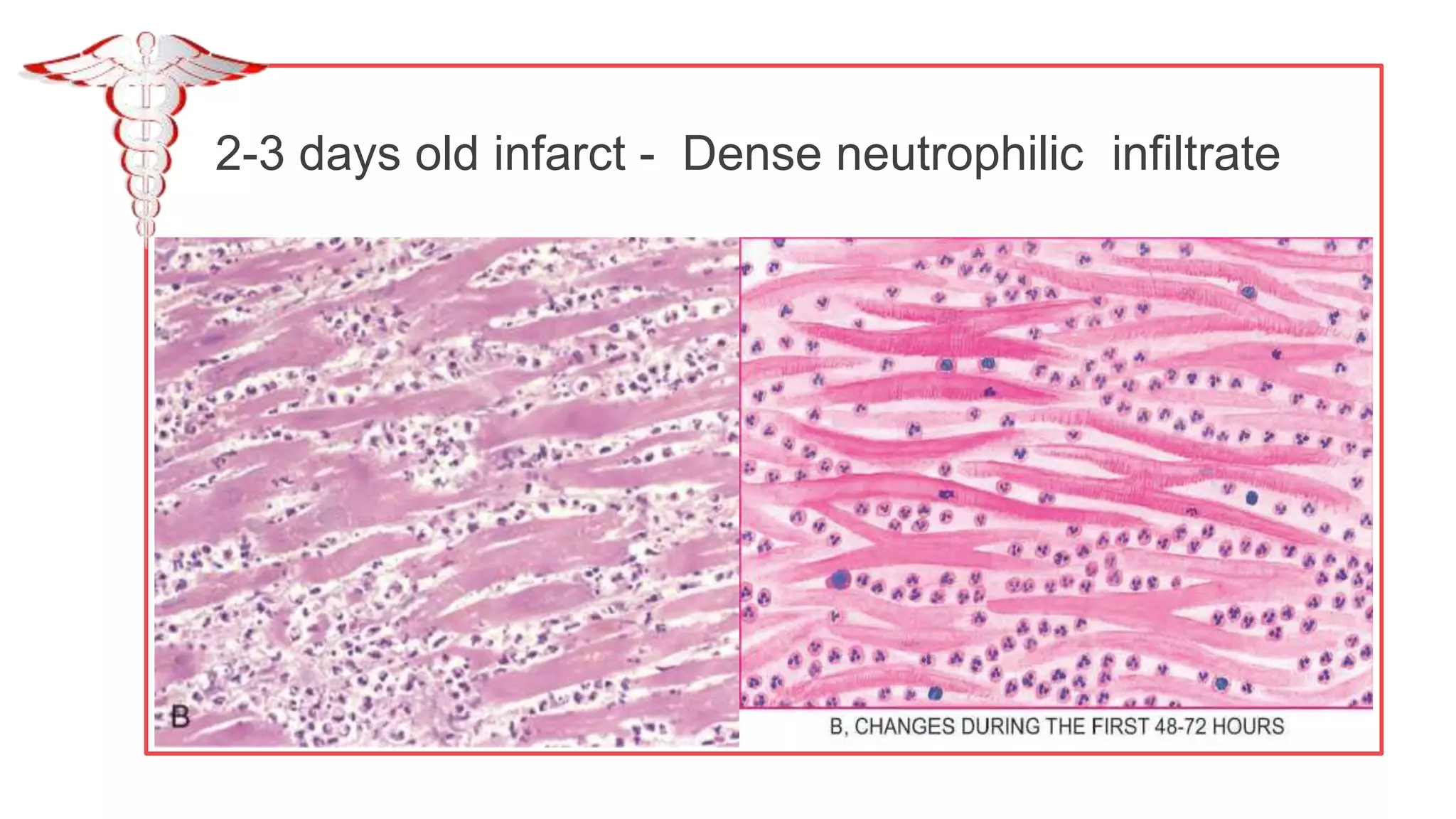 Microscopic changes in Myocardial Infarction | PPTX