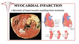 Microscopic changes in Myocardial Infarction | PPTX