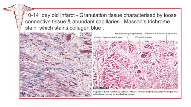 Microscopic changes in Myocardial Infarction | PPTX
