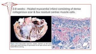 Microscopic changes in Myocardial Infarction | PPTX