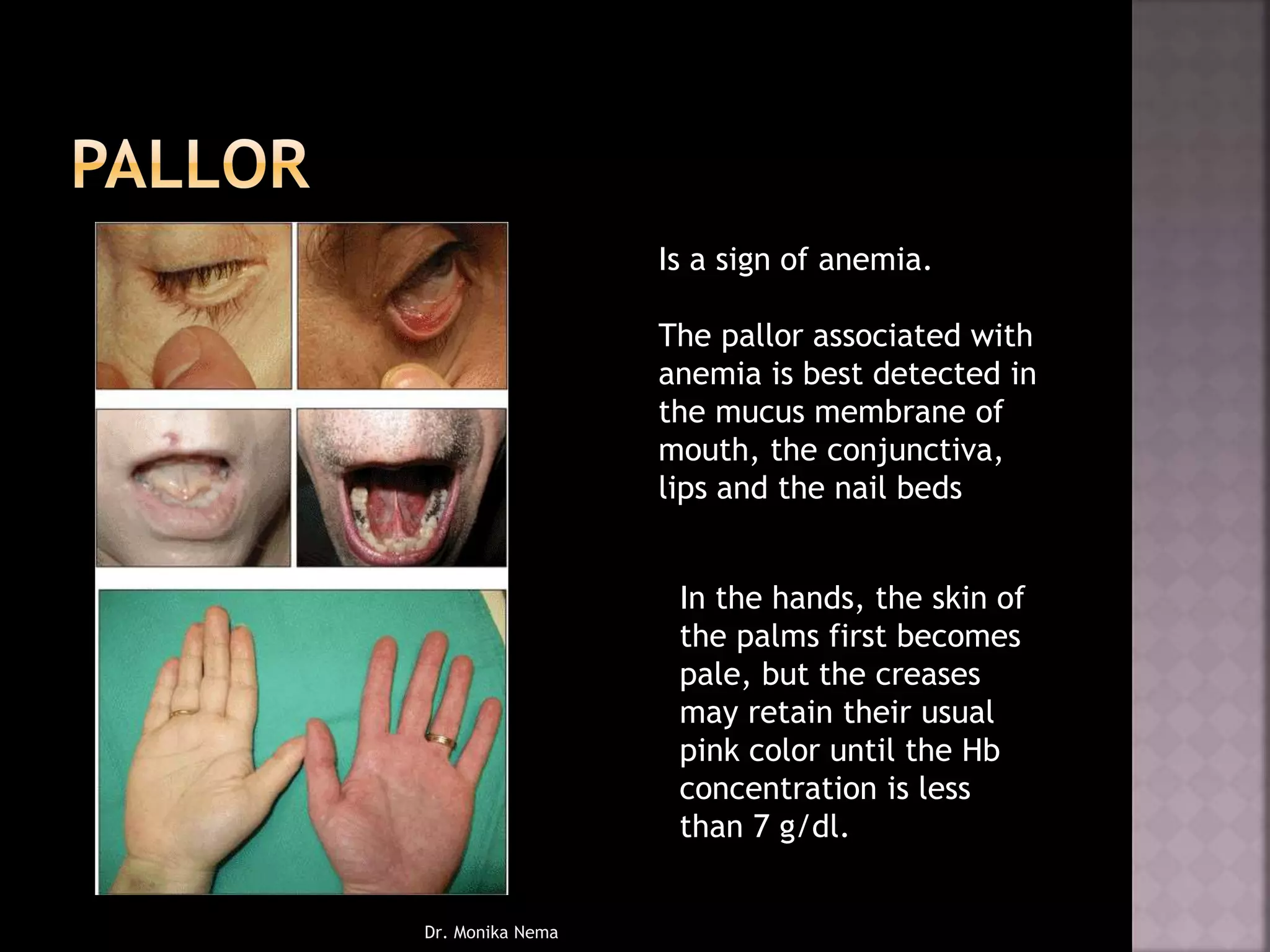 Microcytic anemia | PPTX