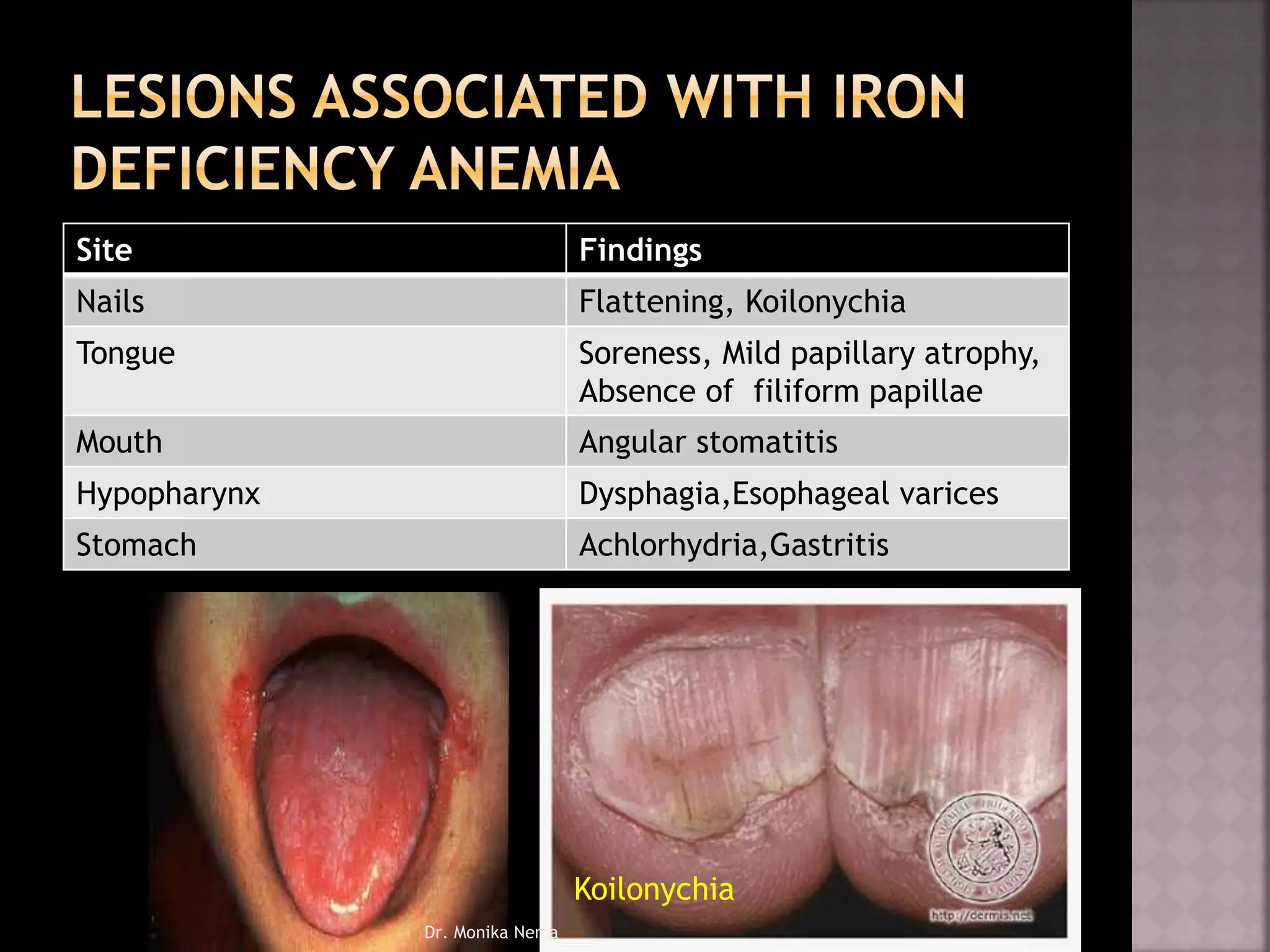 Microcytic anemia | PPTX