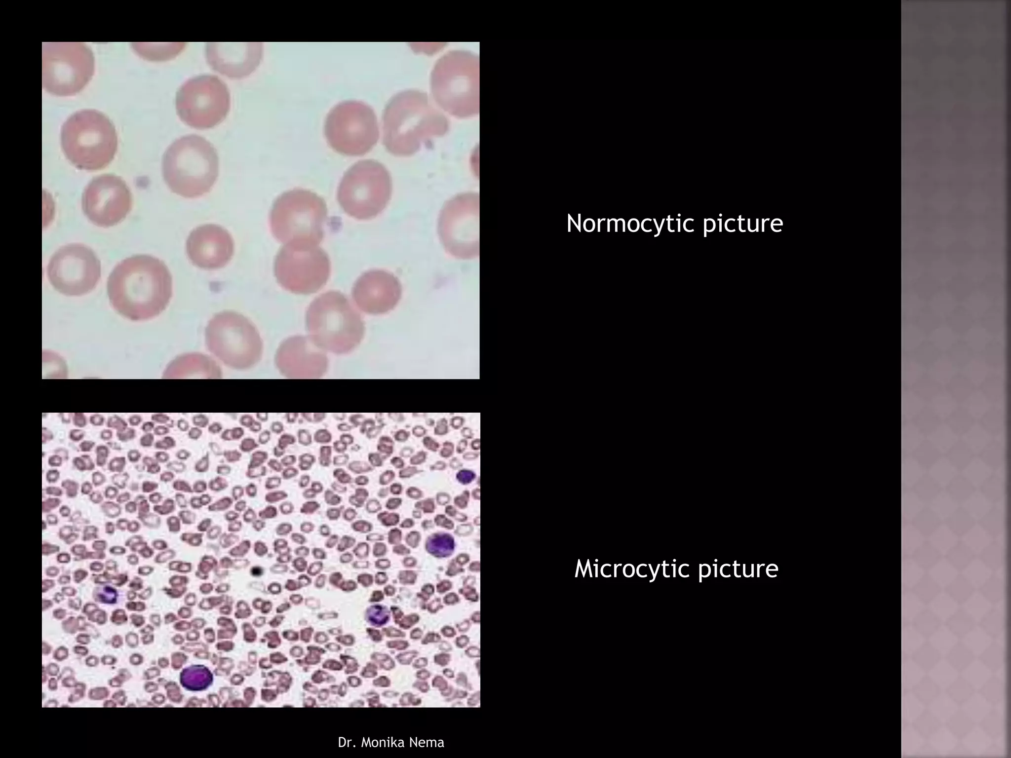 Microcytic anemia | PPTX