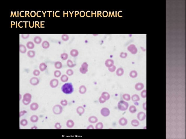 Microcytic anemia | PPTX