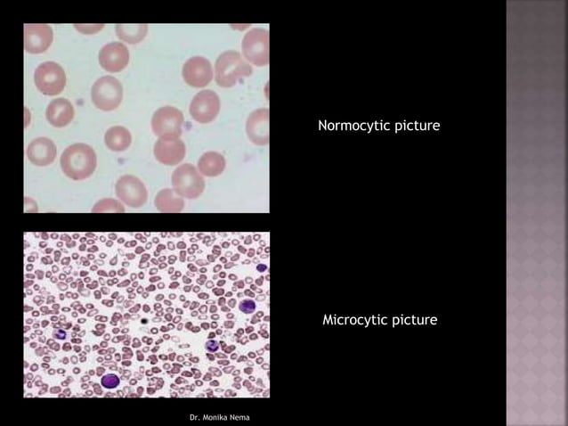 Microcytic anemia | PPTX