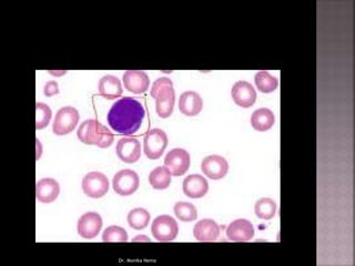Macrocytic Hypochromic Anemia Slide Observations