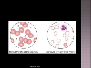 Macrocytic Hypochromic Anemia Slide Observations