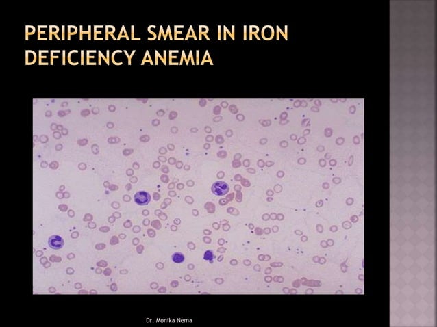 Microcytic anemia