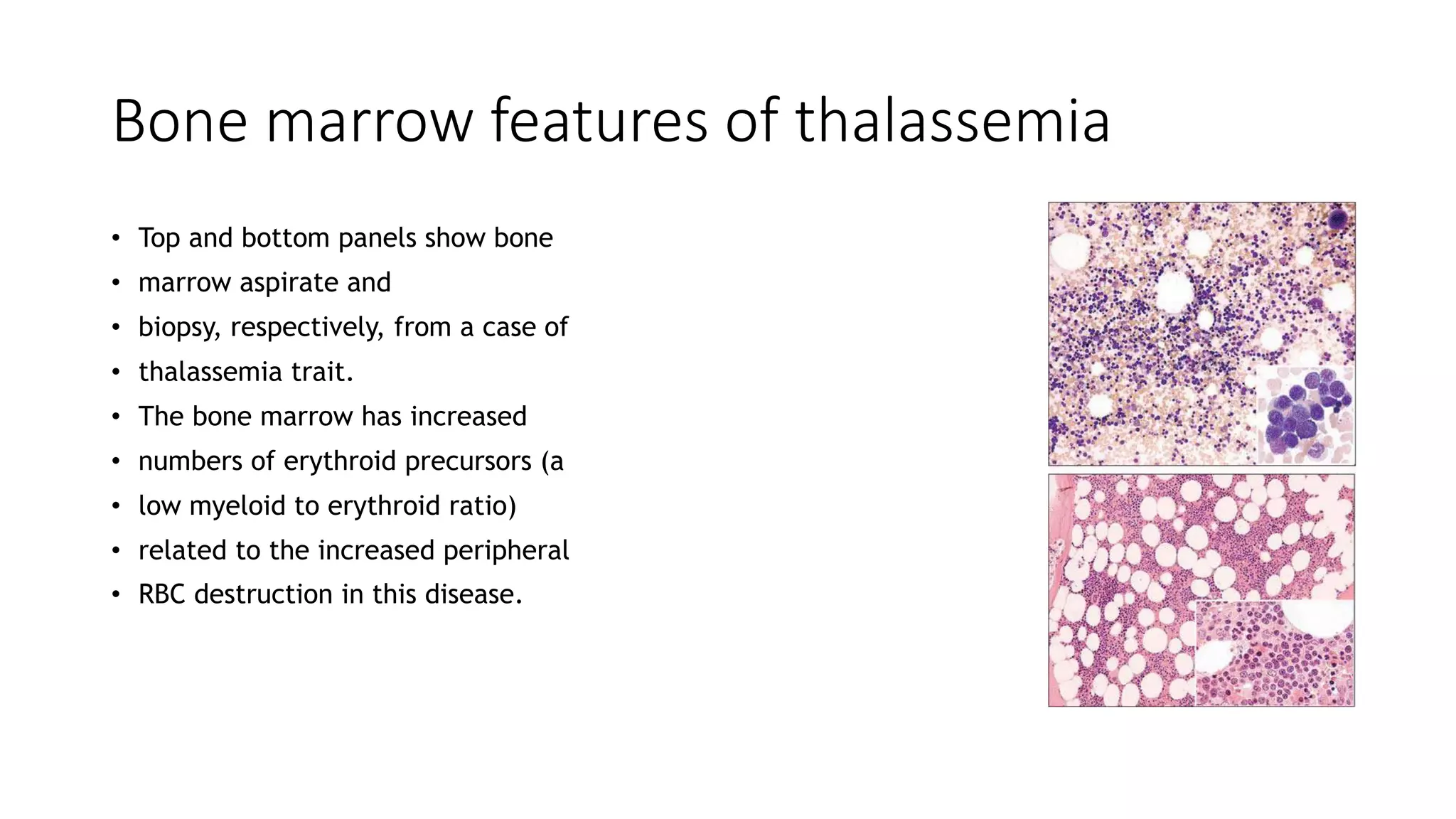 microcytic anemia | PPTX