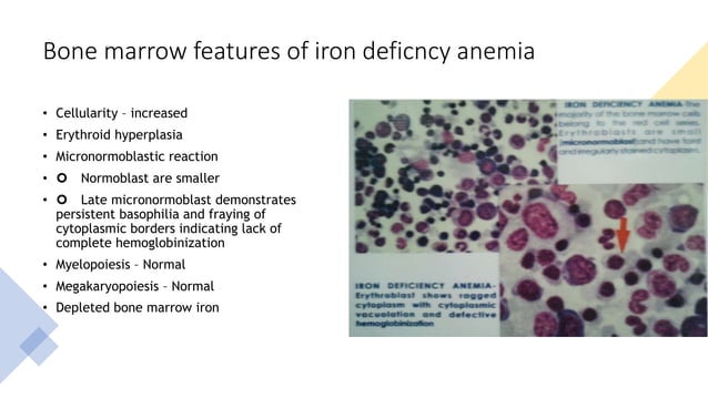 microcytic anemia | PPTX | Digestive Disorders | Diseases and Conditions
