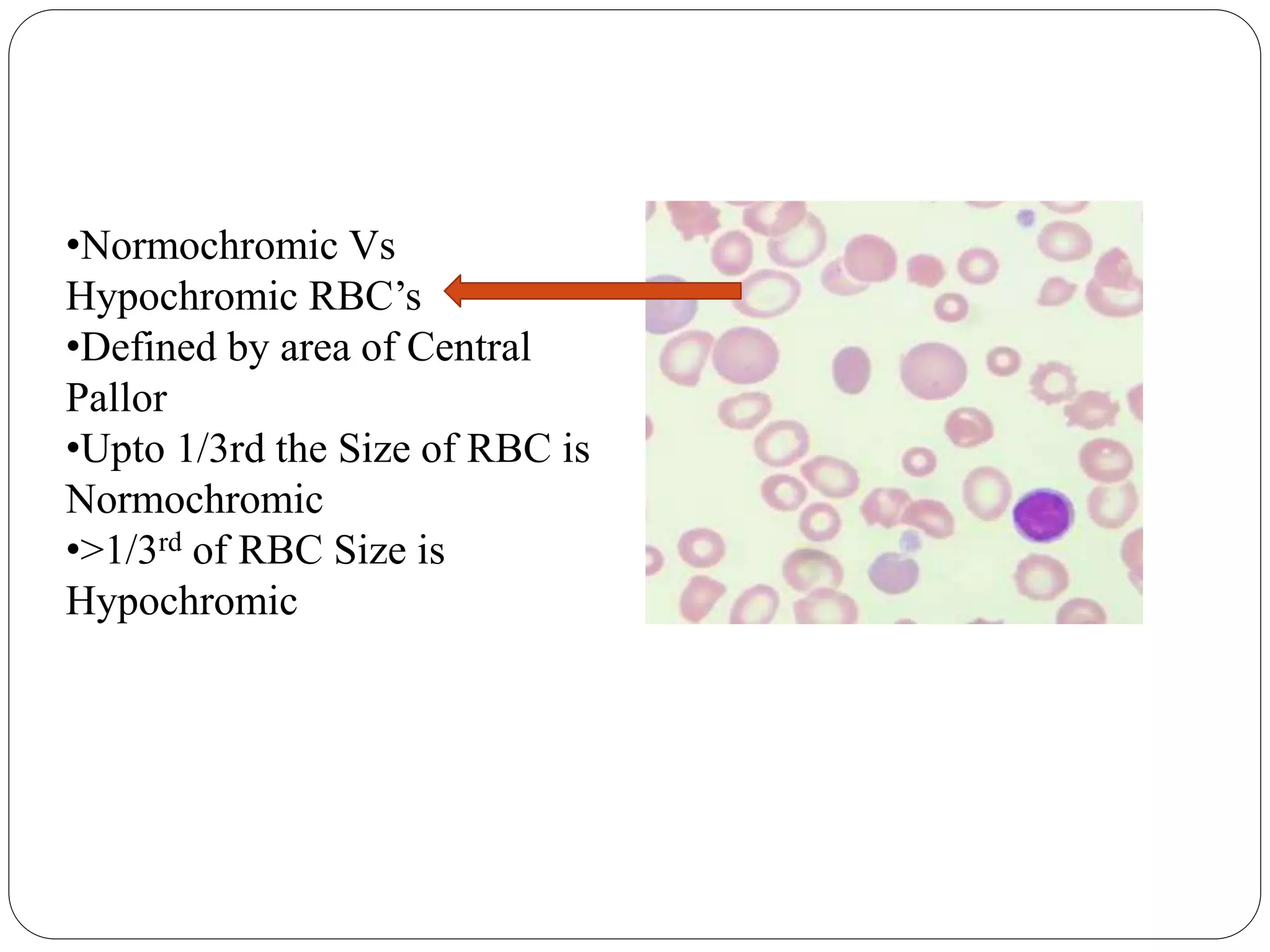 Microcytic hypochromic anemia | PPTX