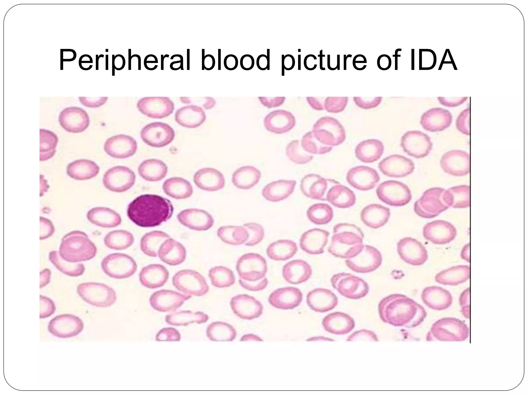Microcytic hypochromic anemia | PPTX