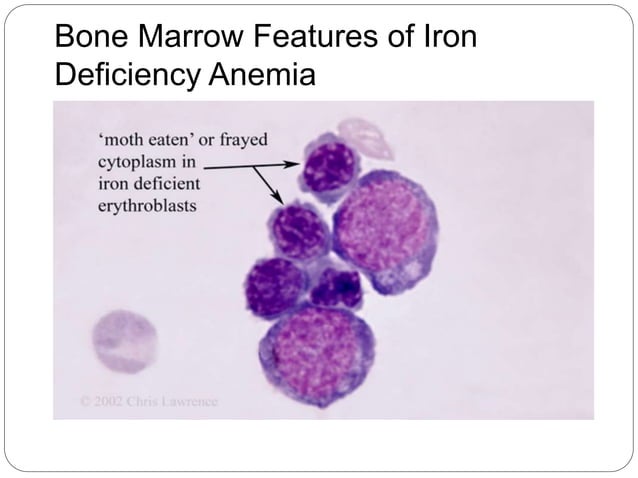 Microcytic hypochromic anemia | PPTX