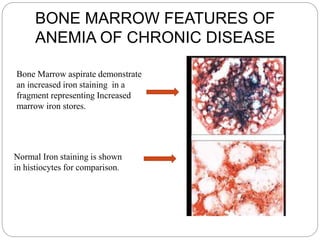 Microcytic hypochromic anemia | PPTX