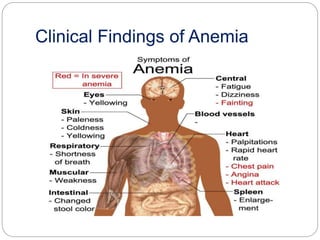 Microcytic hypochromic anemia | PPTX