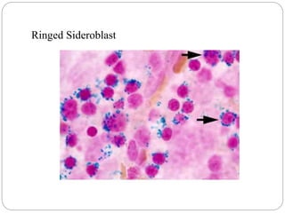 Microcytic hypochromic anemia | PPTX