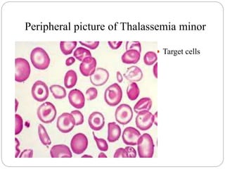 Microcytic hypochromic anemia | PPTX