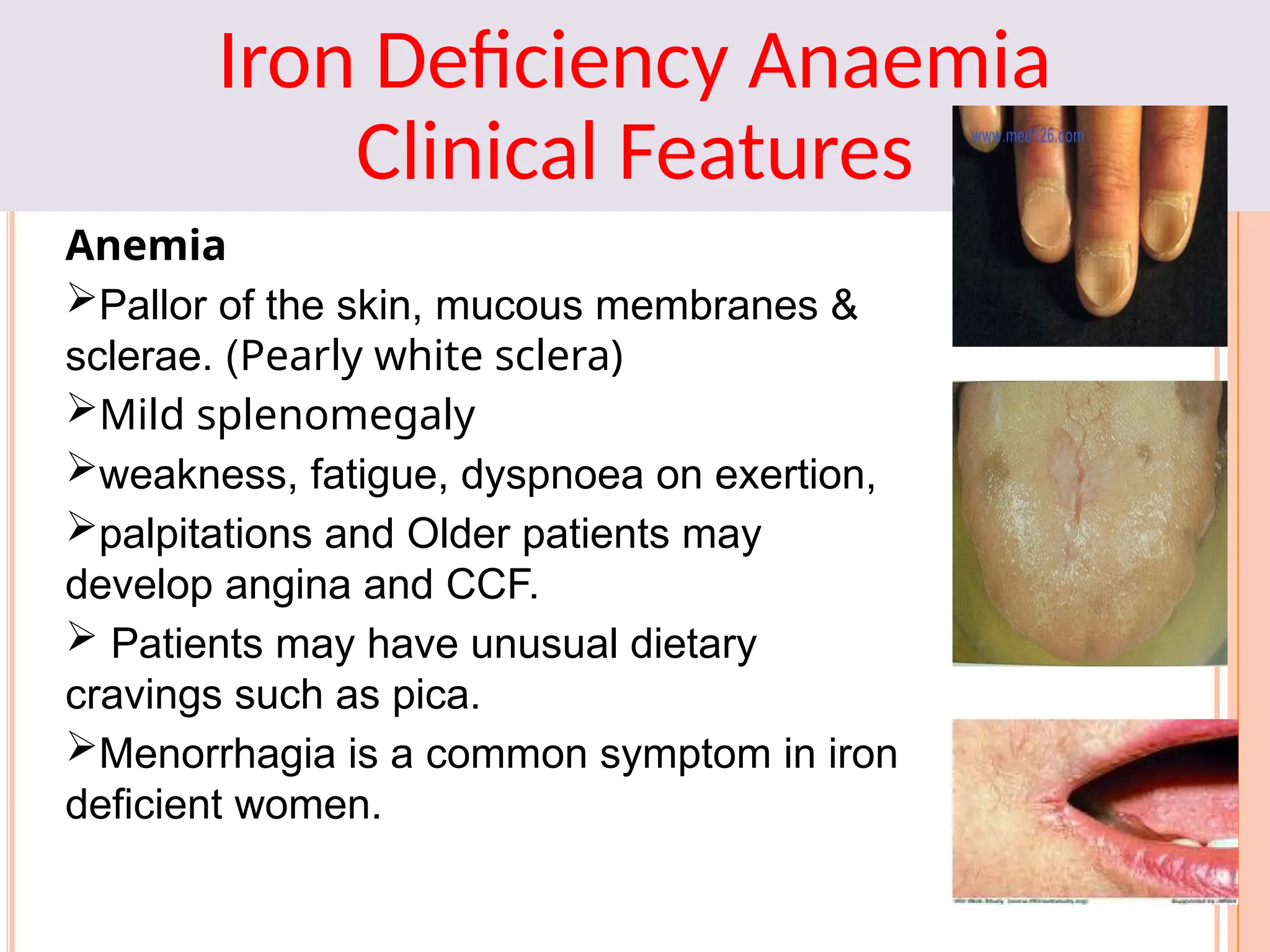 Microcytic Hypochromic Anaemias, Iron Deficiency Anaemia | PPTX