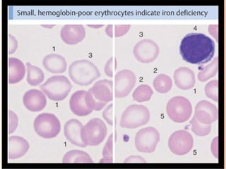 Microcytic Hypochromic Anaemias, Iron Deficiency Anaemia | PPT