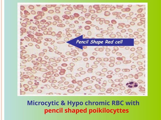 Microcytic Hypochromic Anaemias, Iron Deficiency Anaemia | PPT
