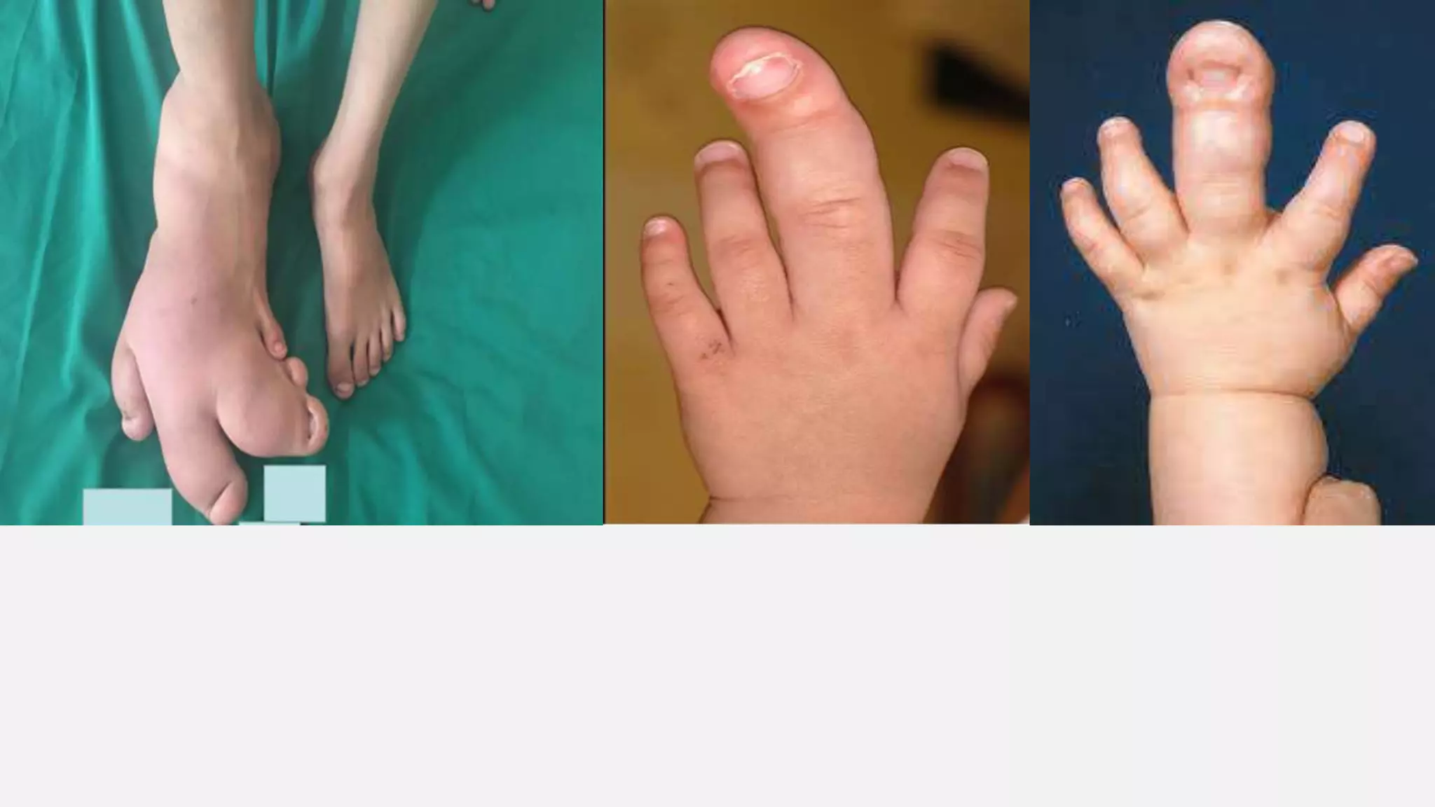 Microdactyly, macrodactyly and hemangioma.ppt