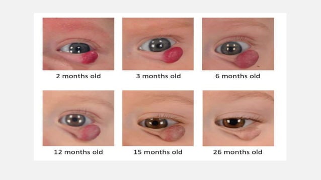 Microdactyly, macrodactyly and hemangioma.ppt