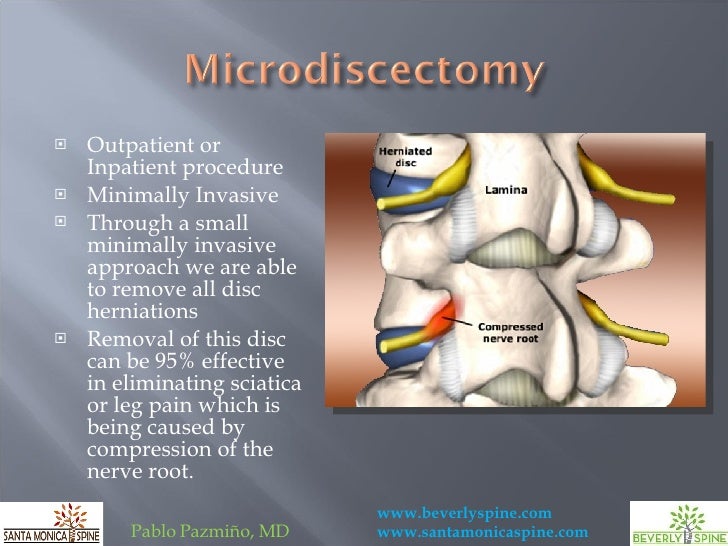 Microdiscectomy by Pablo Pazmino MD