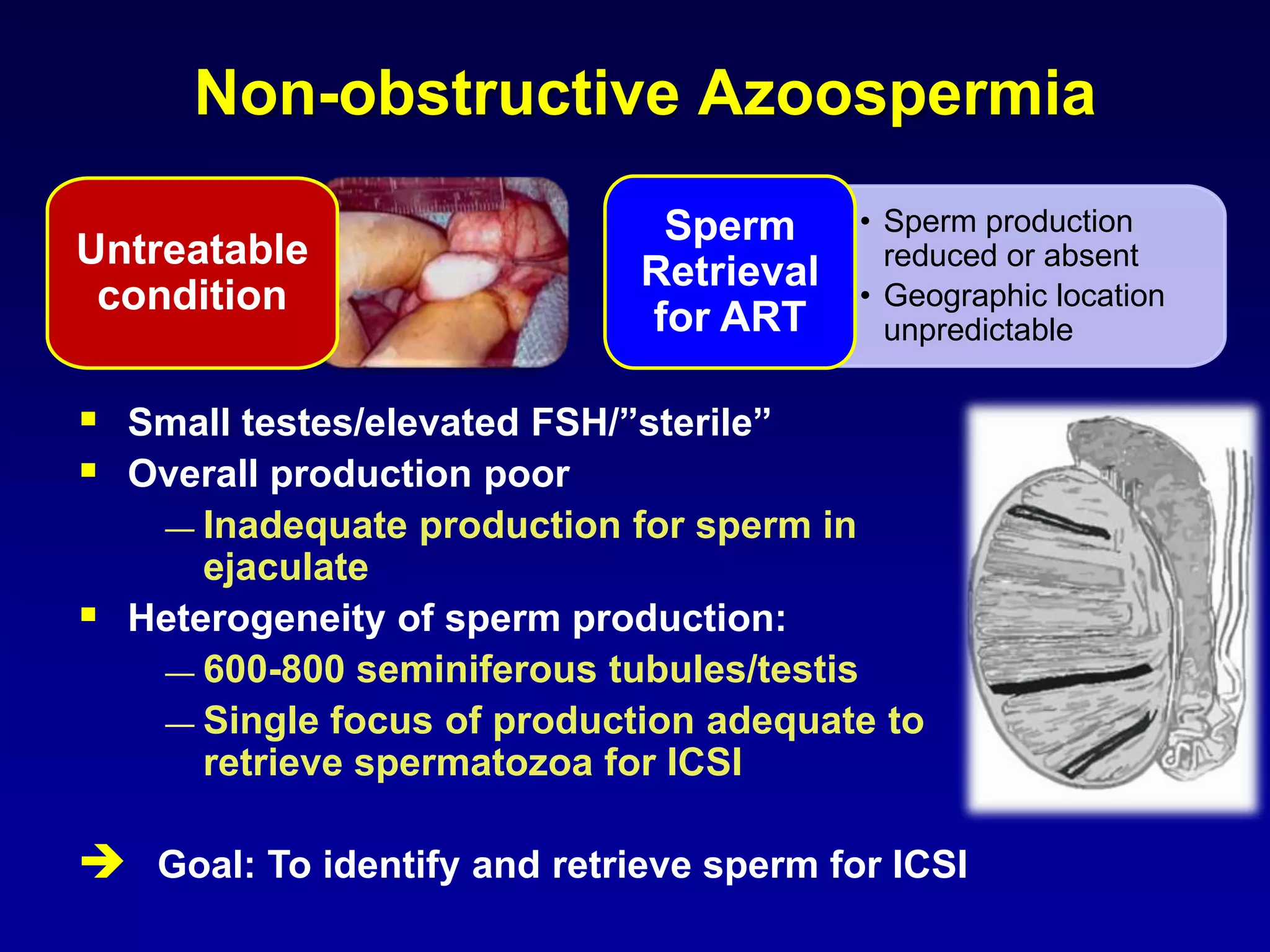 Microdissection testicular sperm extraction | PPTX