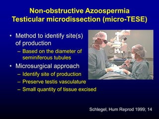 Microdissection testicular sperm extraction | PPTX