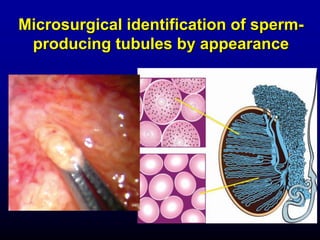 Microdissection testicular sperm extraction | PPTX