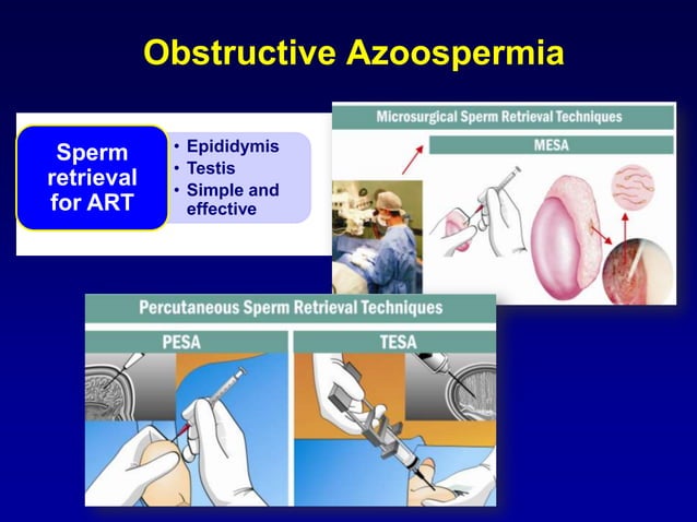 Microdissection testicular sperm extraction | PPTX