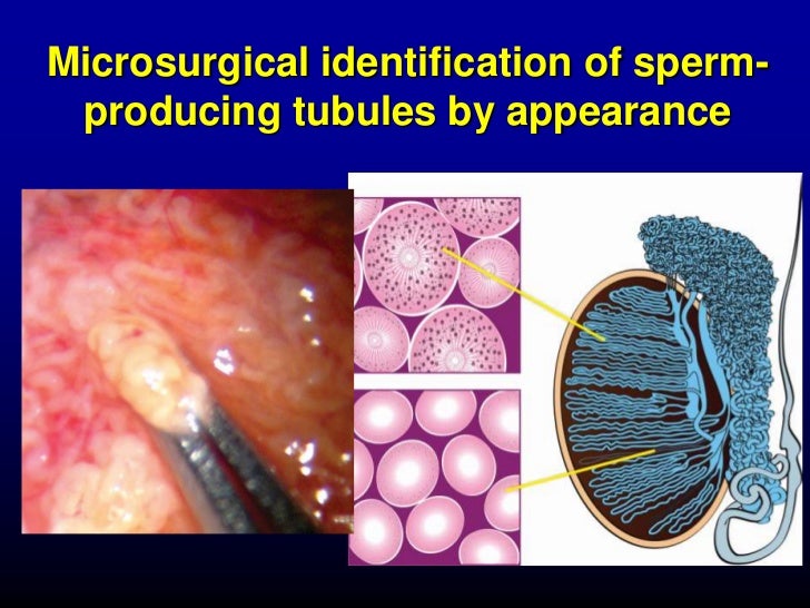 Microdissection Testicular Sperm Extraction