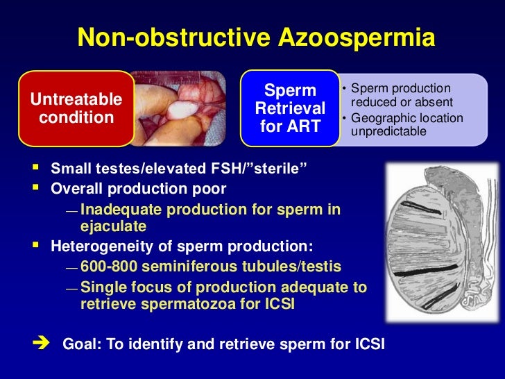 Microdissection Testicular Sperm Extraction