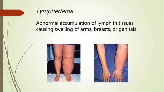 Microfilariae (Wuchereria Bancrofti) | PPTX