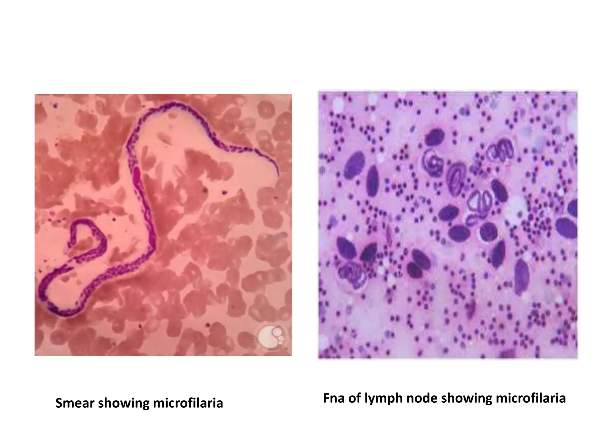 microfilariya hemat.pptx