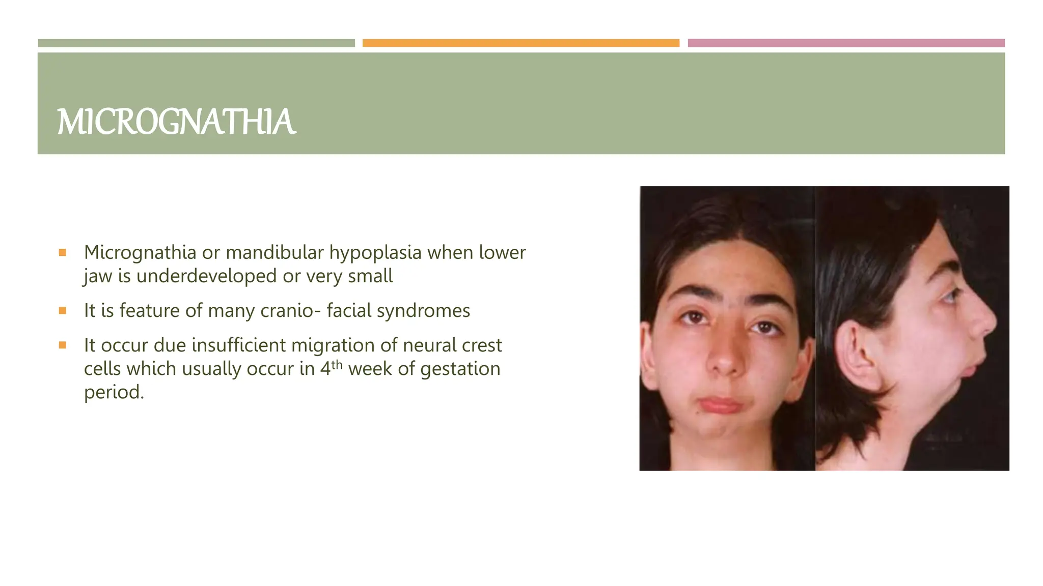 micrognathic syndromes affecting oral cavity | PPTX